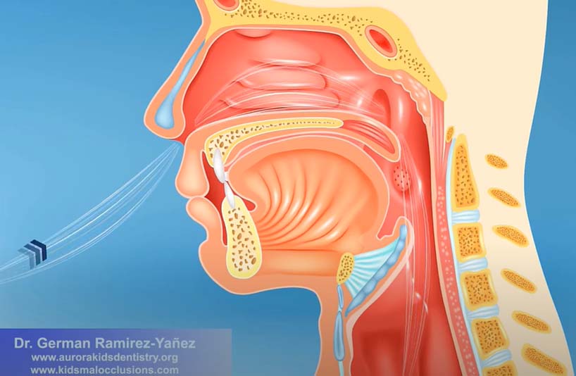 Mouth Breathing in Children from Dr. German Ramirez | Dr Shereen Lim